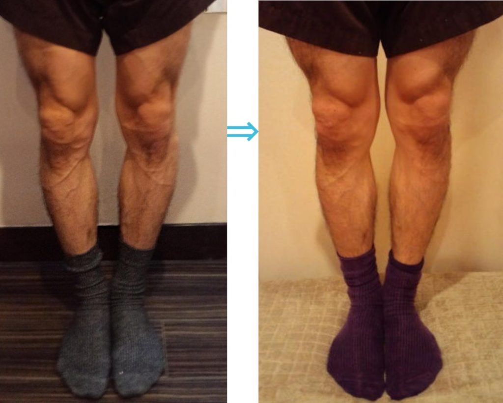 O-leg/X-leg correction treatment | 新横浜 足と爪の痛みセンター （旧巻き爪救急センター）